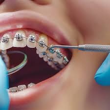 ORTHODONTICS (ONE Arch) – Perla Dental